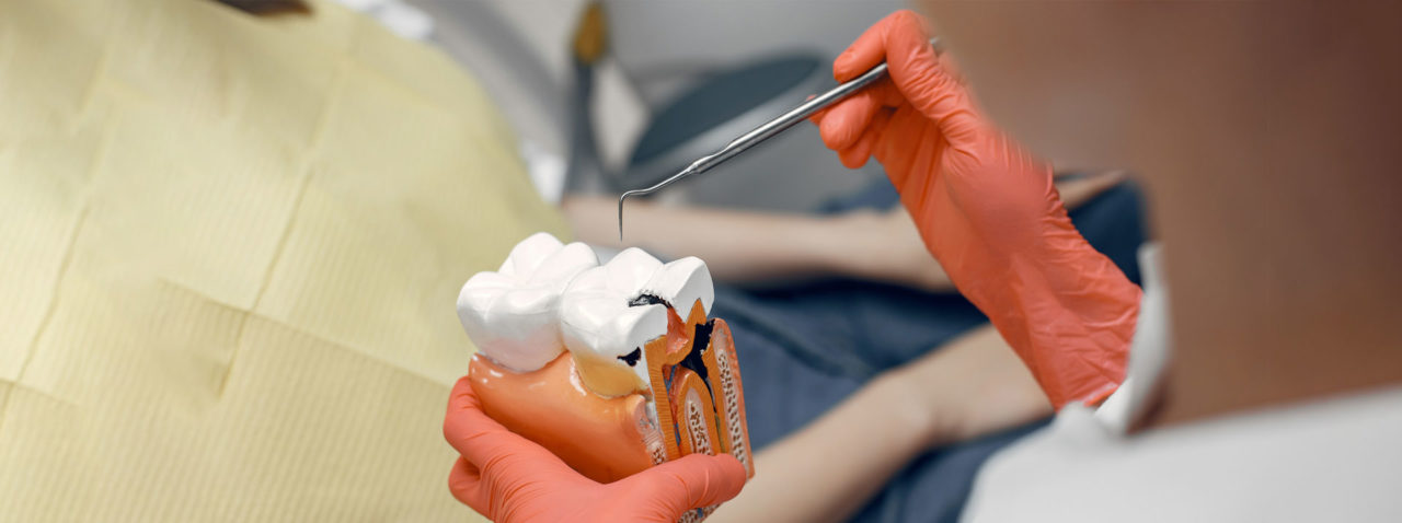 Kök Kanal Tedavisi - Maxilla Dental Toronto