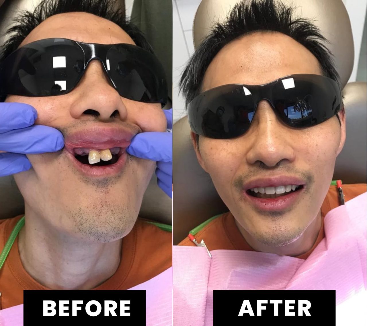 Full Mouth Restoration - Maxilla Dental Clinic